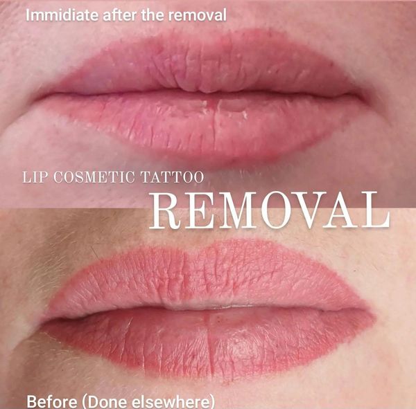 COSMETIC TATTOO REMOVAL | Infinity Cosmetic Tattoo